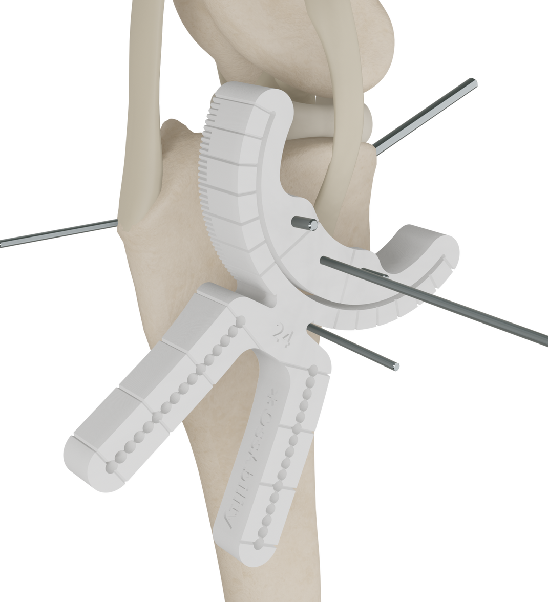 Guided TPLO – OssAbility Limited