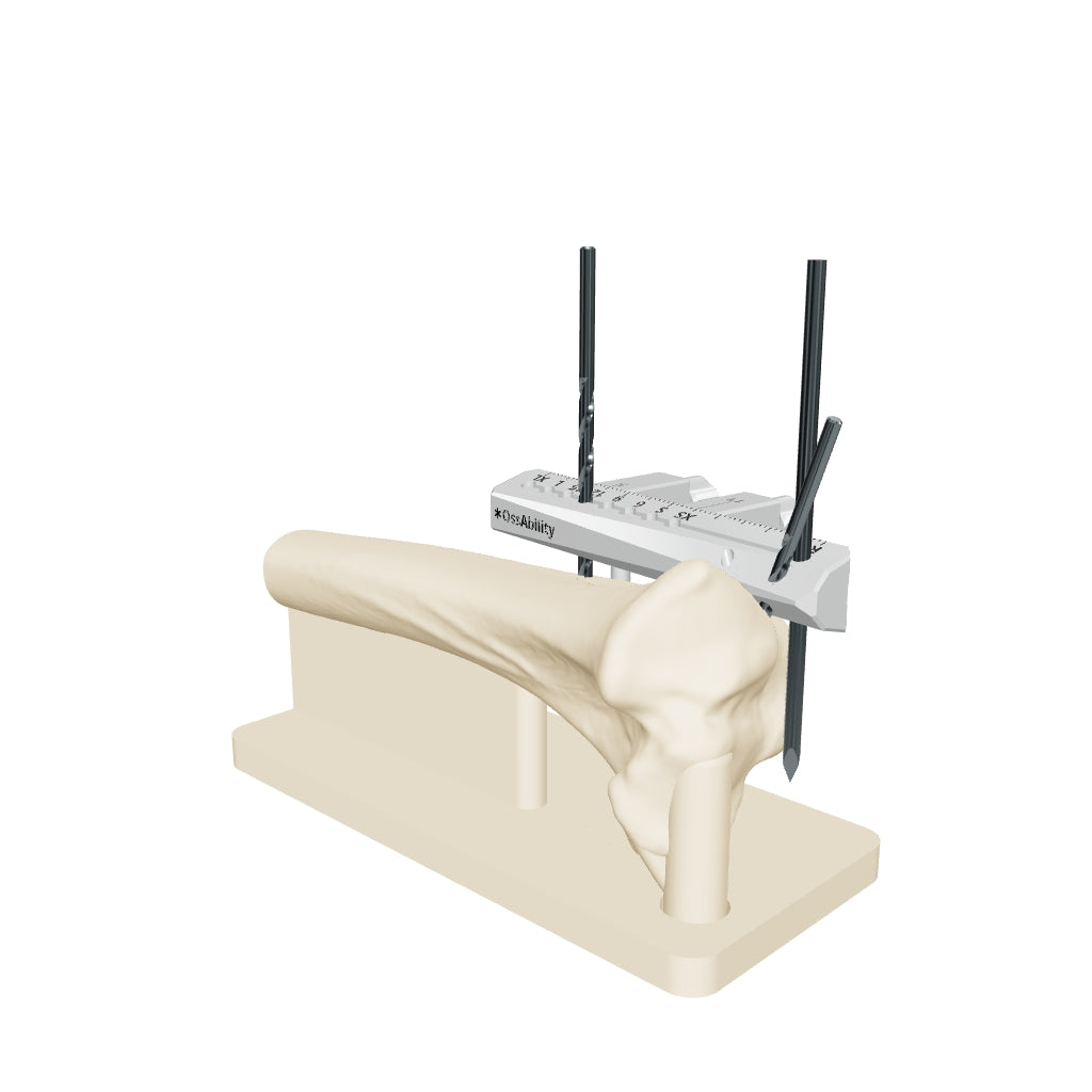 Guided TTA Instrument Set – OssAbility Limited